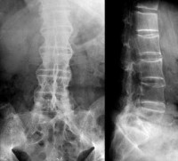 Galeria de fotos :: espondilite anquilosante